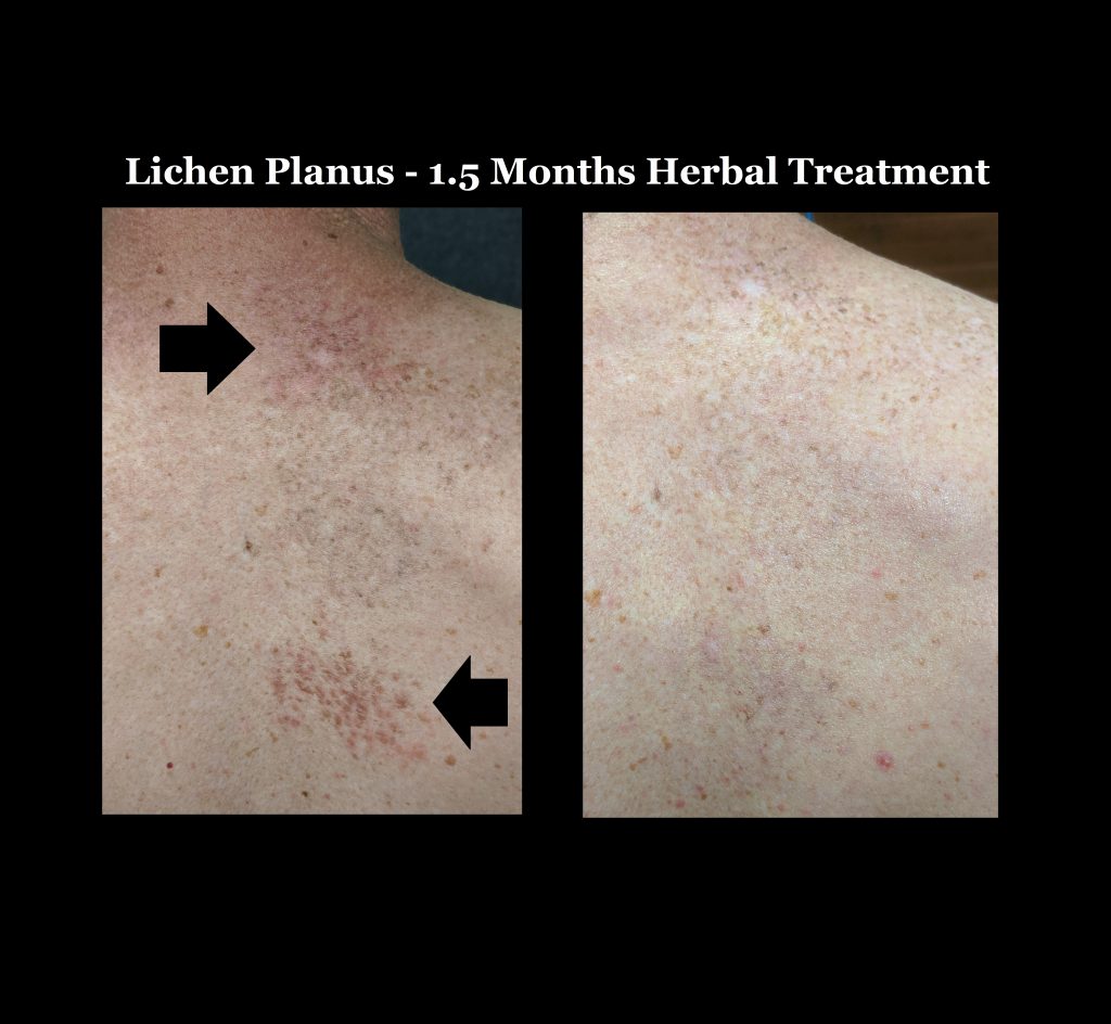Lichen Planus, Chinese Medical Dermatology | Oakland Hills Acupuncture