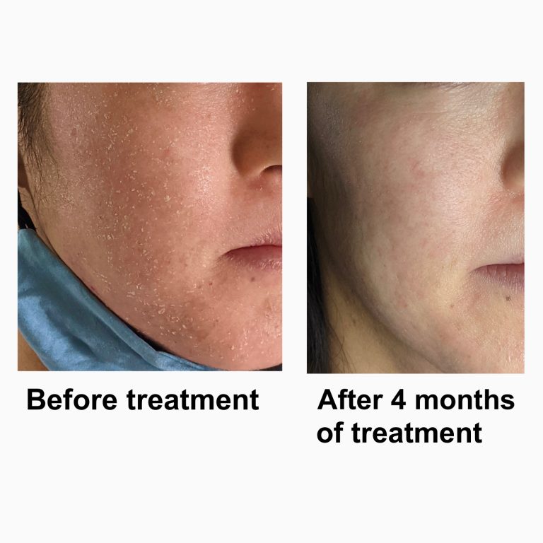 Topical Steroid Withdrawal (TSW) - Oakland Hills Acupuncture